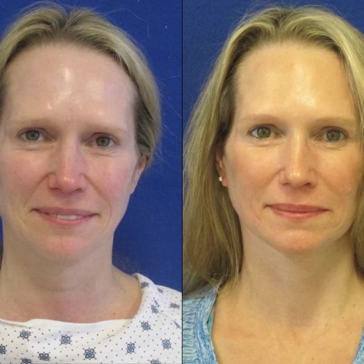 Mini Facelift - Maia Plastic Surgery