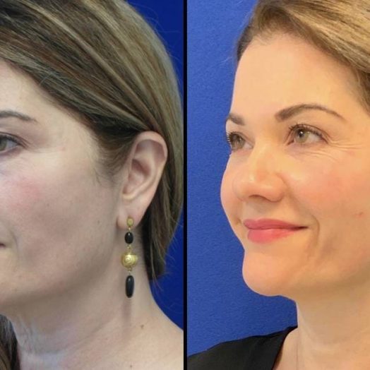 Mini Facelift - Maia Plastic Surgery