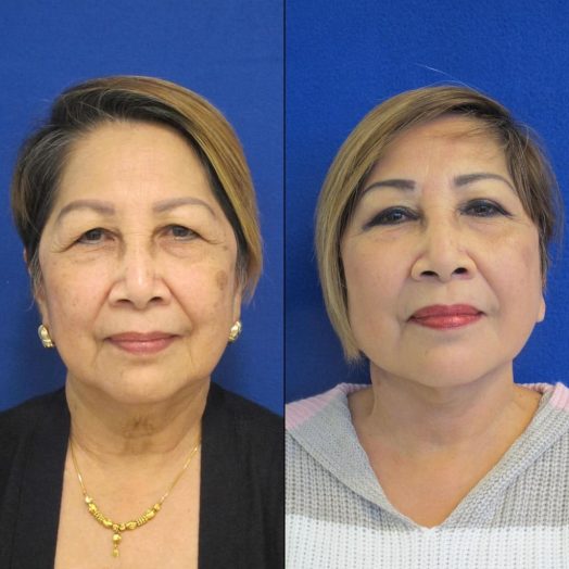 Mini Facelift - Maia Plastic Surgery