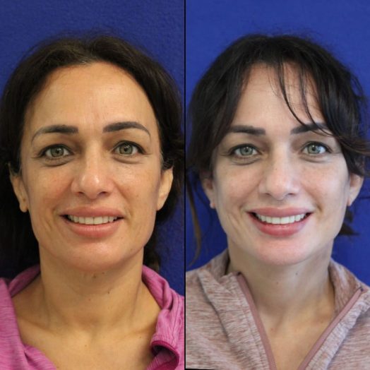 Mini Facelift - Maia Plastic Surgery