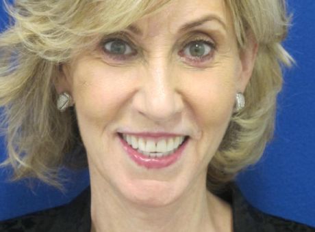 TCA Peels | Washington DC