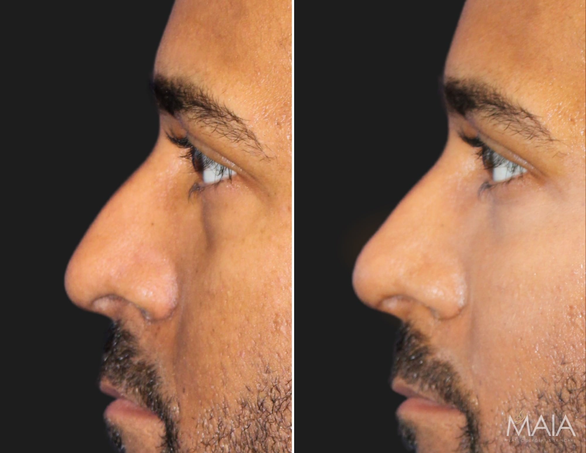 Juvederm Eyes Crescent