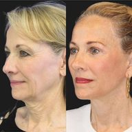 Washington DC Plastic Surgery | Tysons Corner Facelift, Rhinoplasty ...